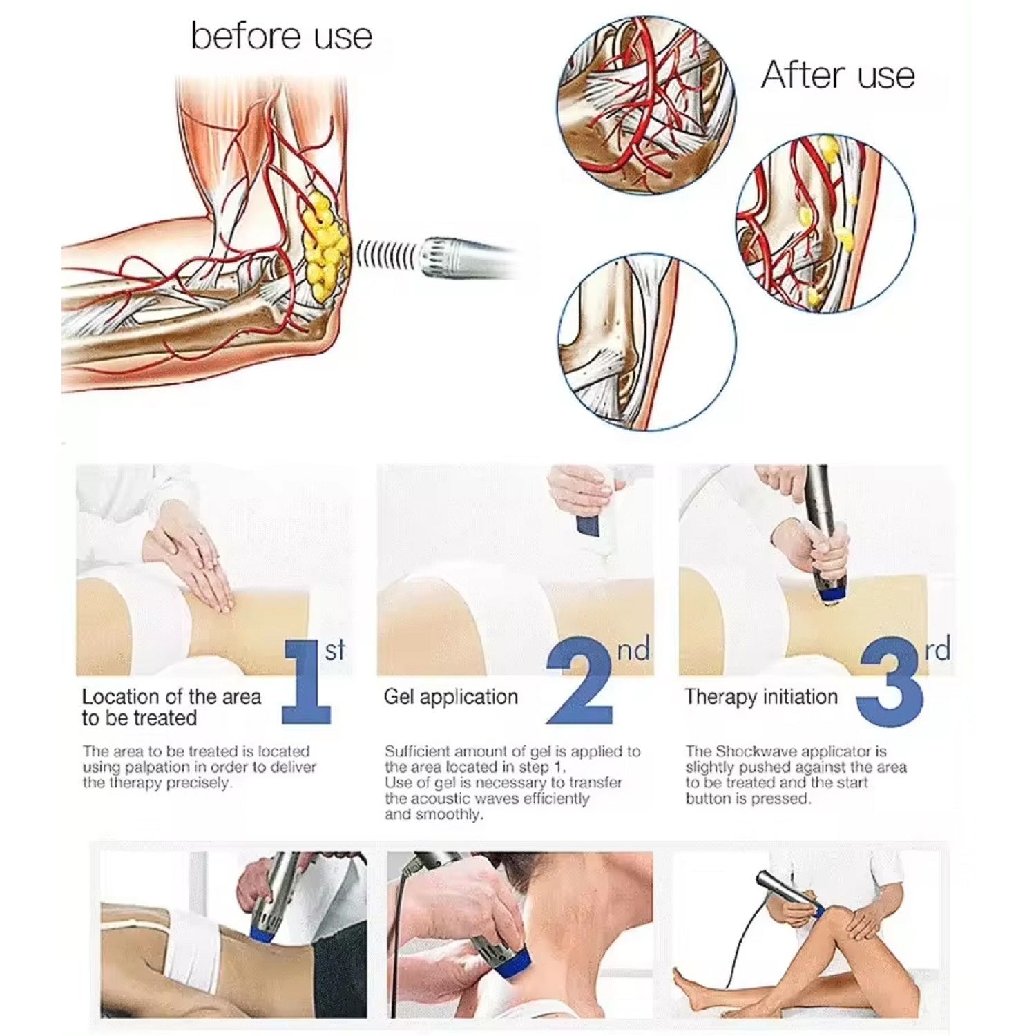 Electromagnetic Shockwave Therapy for ED Treatment – Oxygenator Machine